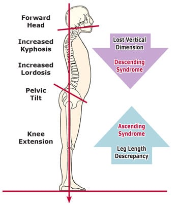 Forward Head Posture – Part 2 - Erik Dalton Blog