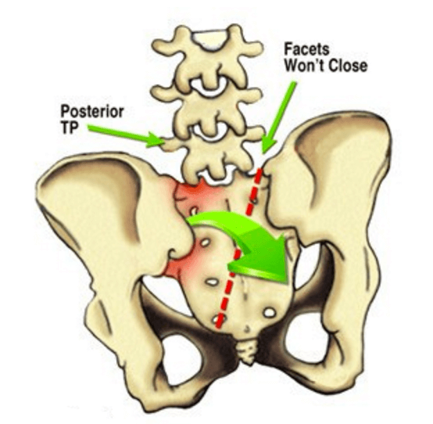 Bending and Twisting Back Pain - Erik Dalton Blog