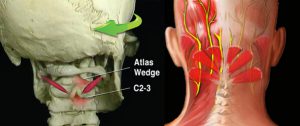Suboccipital Triangle & Headaches - Erik Dalton Blog