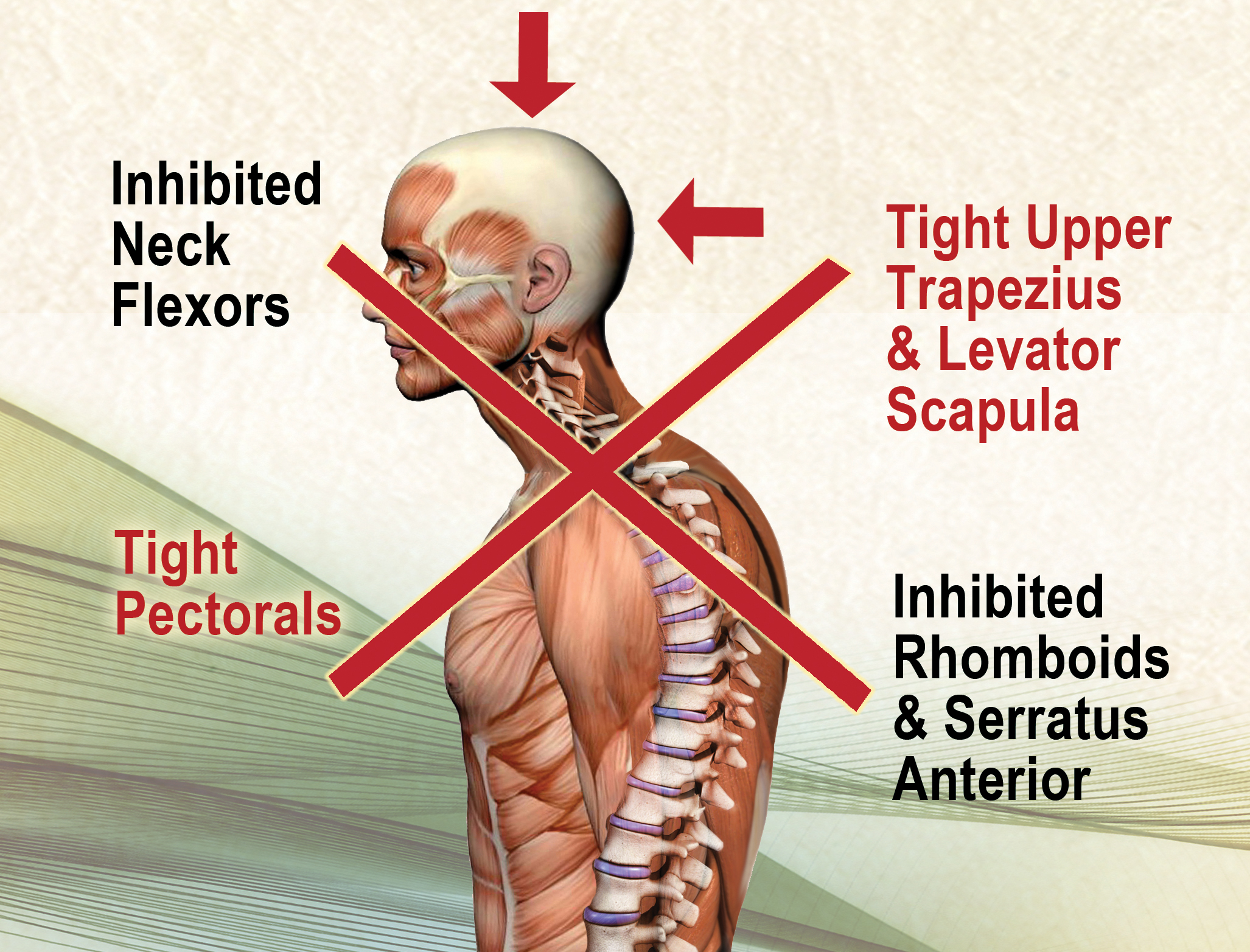 Upper Crossed Postural Syndrome Upper Crossed Syndrome | PDF