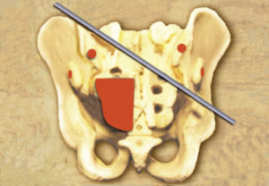 What is Sacral Torsion? - Erik Dalton Blog
