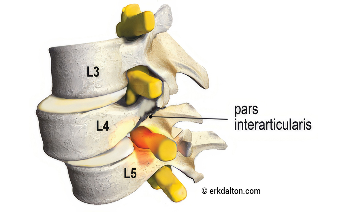 How Do Ligaments Cause Sciatica? - Erik Dalton Blog