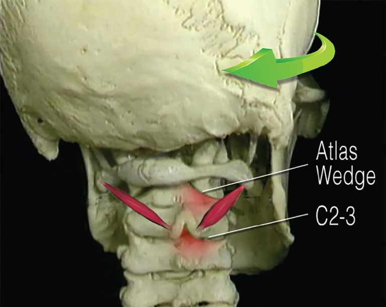 Stomach-Sleeper’s Headache - Erik Dalton Blog