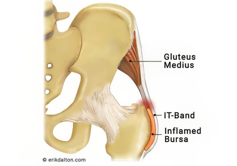 Deep Gluteal Syndrome and Tendinopathy - Erik Dalton Blog