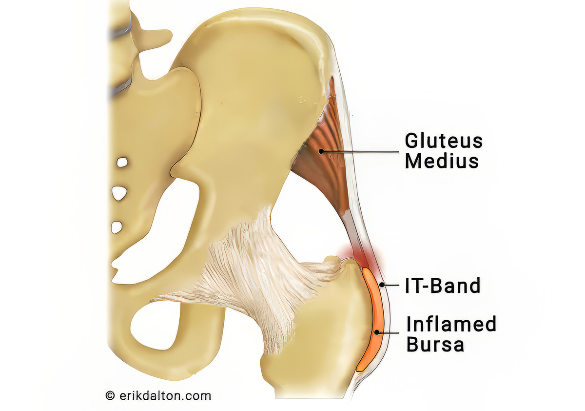 Deep Gluteal Syndrome and Tendinopathy - Erik Dalton Blog