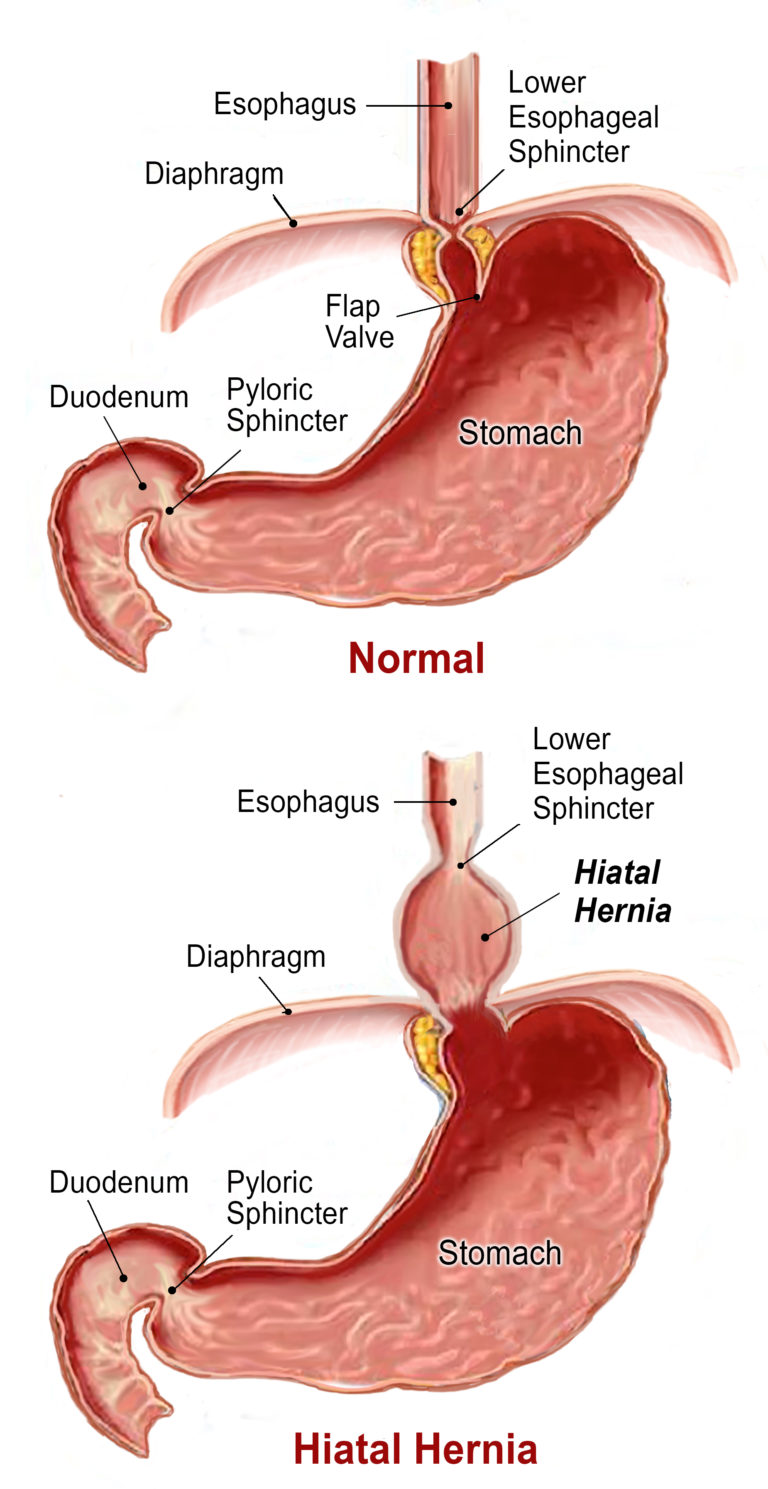 Hiatal Hernia, Acid Reflux and GERD