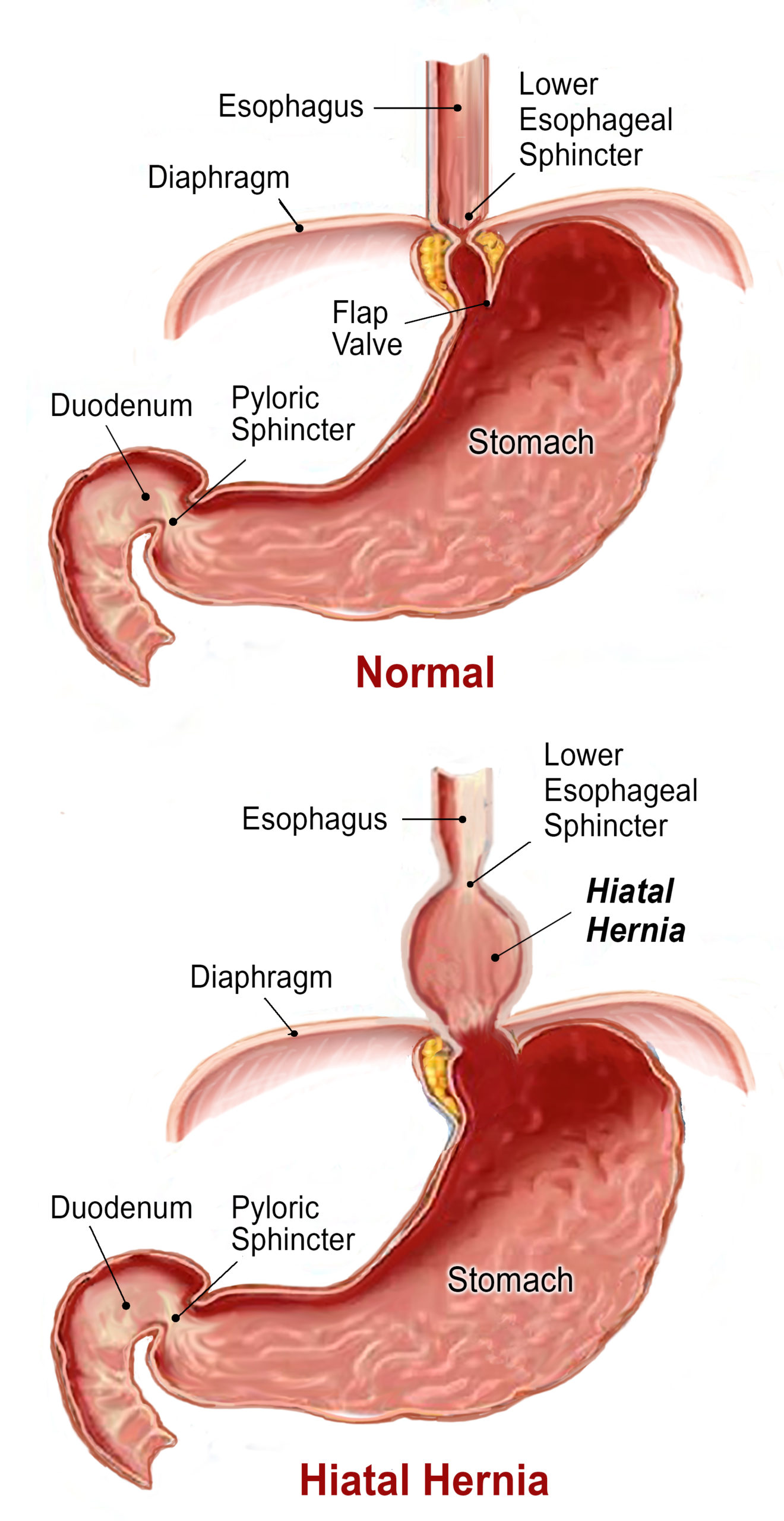 Hiatal Hernia, Acid Reflux and GERD